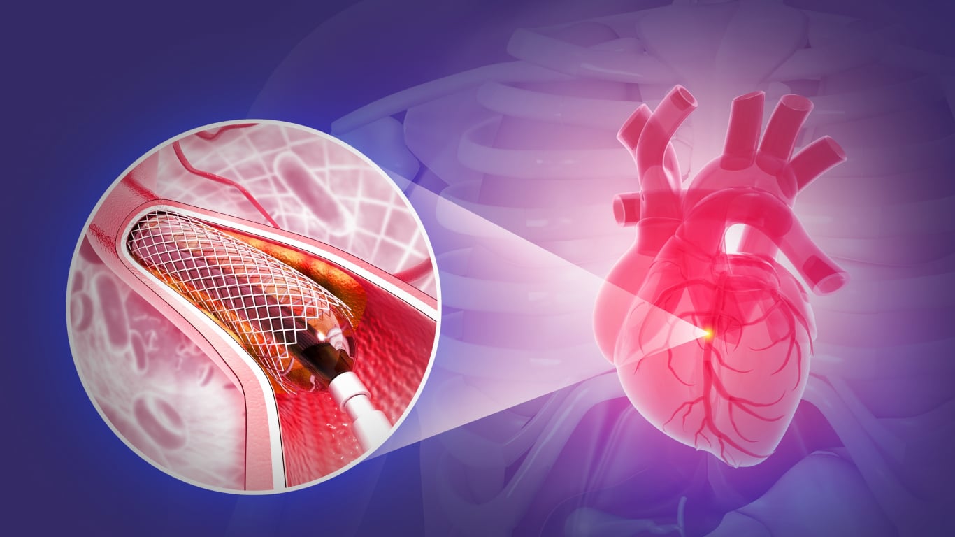10 svarīgi jautājumi par sirds asinsvadiem un stentiem — Santa